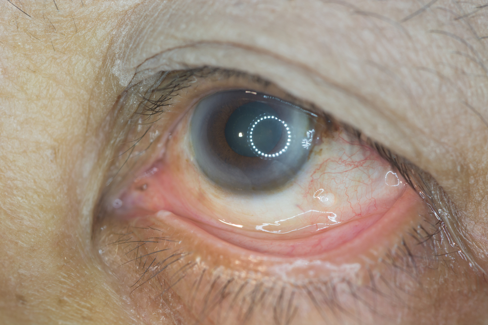 Diabetic Retinopathy Cured At IClinix ICLINIX